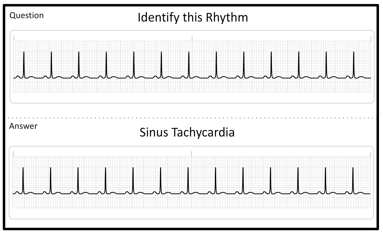 Rhythm Review Flashcards | Prepare ACLS/BLS exam | ACLS Certification ...