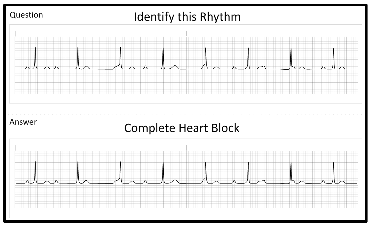 Rhythm Review Flashcards | Prepare ACLS/BLS exam | ACLS Certification ...