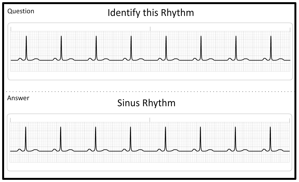Rhythm Review Flashcards | Prepare ACLS/BLS exam | ACLS Certification ...
