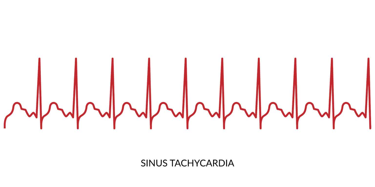 Topic - ACLS Case: Adult Tachycardia with a Pulse | ACLS Course | ACLS ...