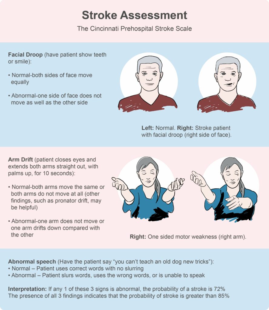 Topic - ACLS Case: Acute Stroke | ACLS Course | ACLS Certification ...