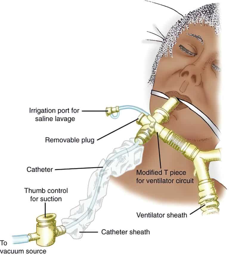 Topic - Adjuncts for Airway Control and Ventilation | ACLS Course ...