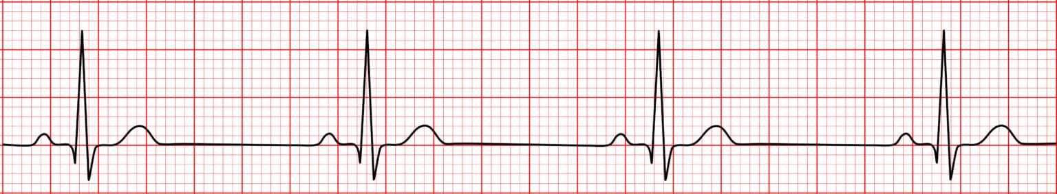 Topic - ACLS Case: Symptomatic Bradycardia | ACLS Course | ACLS ...