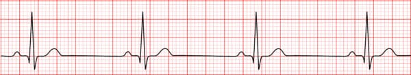 Topic - ACLS Case: Symptomatic Bradycardia | ACLS Course | ACLS ...