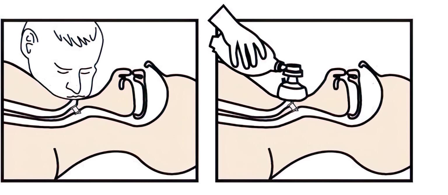 Topic - Adjuncts for Airway Control and Ventilation | ACLS Course ...