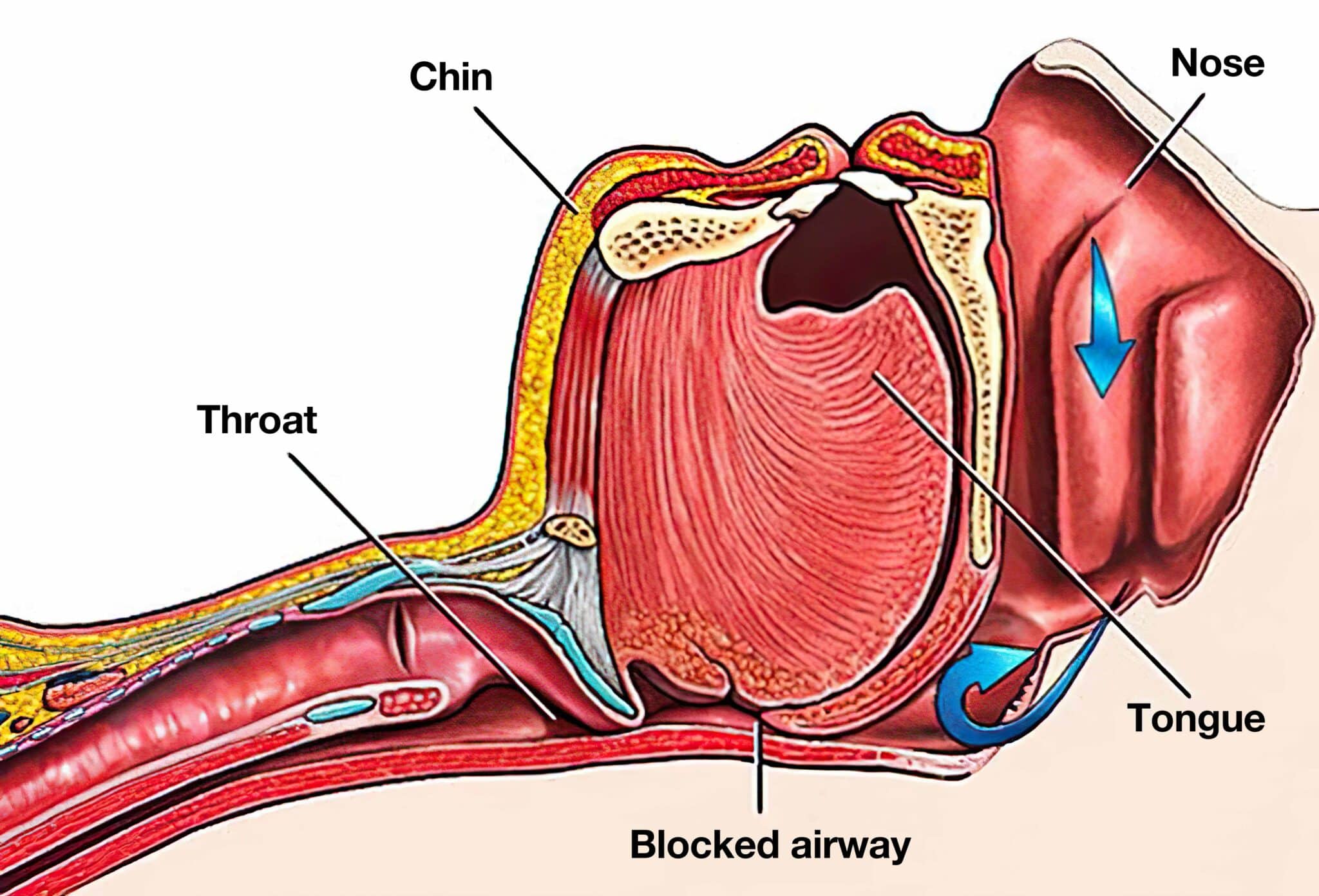 Topic - ACLS Case: Respiratory Arrest | ACLS Course | ACLS ...