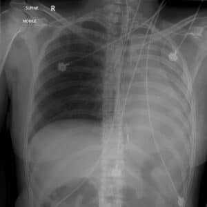 Topic - Adjuncts for Airway Control and Ventilation | ACLS Course ...