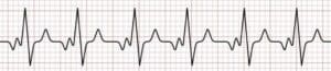 Pediatric Tachycardia with a Pulse Algorithm | PALS Algorithms | ACLS ...