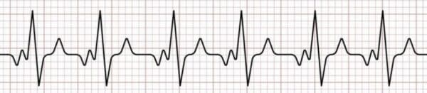 Pediatric Tachycardia with a Pulse Algorithm | PALS Algorithms | ACLS ...