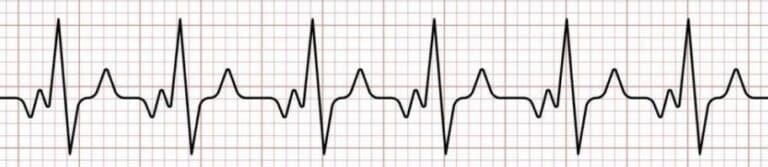 Pediatric Tachycardia with a Pulse Algorithm | PALS Algorithms | ACLS ...