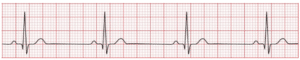 Pediatric Bradycardia with a Pulse & Poor Perfusion Algorithm | PALS ...