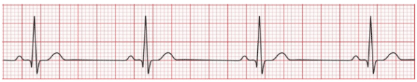Pediatric Bradycardia with a Pulse & Poor Perfusion Algorithm | PALS ...