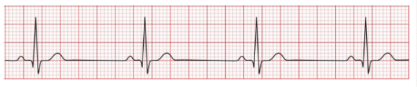 Adult Bradycardia Algorithm | ACLS Certification Association