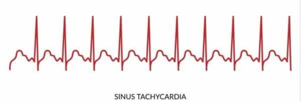 Adult Tachycardia Algorithm | ACLS Algorithms | ACLS Certification ...