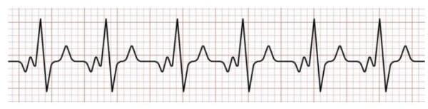 Checklist for Fibrinolytic Therapy Algorithm | ACLS Algorithms | ACLS ...