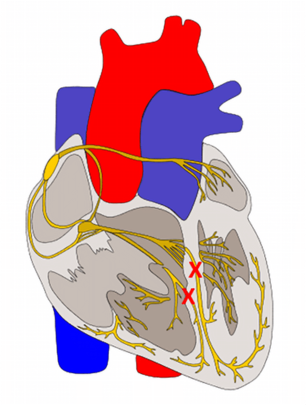 Cardiac Blocks Quiz | 12-Lead ECG Practice Test Online | ACLS ...