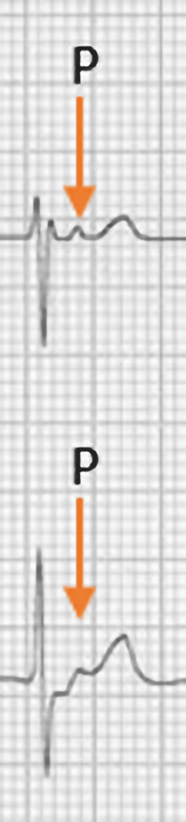 AV Rhythms Quiz 1 | 12-Lead ECG Practice Test Online | ACLS ...