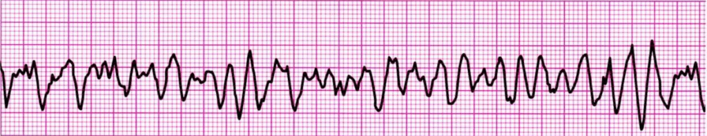 ACLS Principles Quiz 9 | ACLS Practice Test Online | ACLS Certification ...