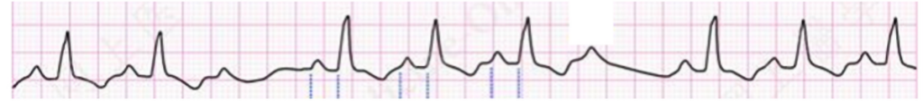 Rhythm Strip Identification Quiz 1 | Arrhythmia Interpretation Practice ...