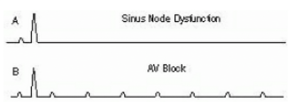 Sinus Rhythms Quiz | Arrhythmia Interpretation Practice Test Online ...
