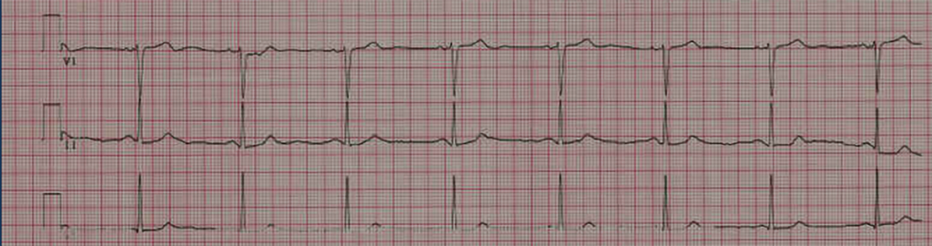 Rhythm Strip Identification Quiz 1 | Arrhythmia Interpretation Practice ...