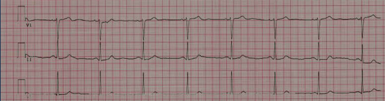 Rhythm Strip Identification Quiz 1 | Arrhythmia Interpretation Practice ...