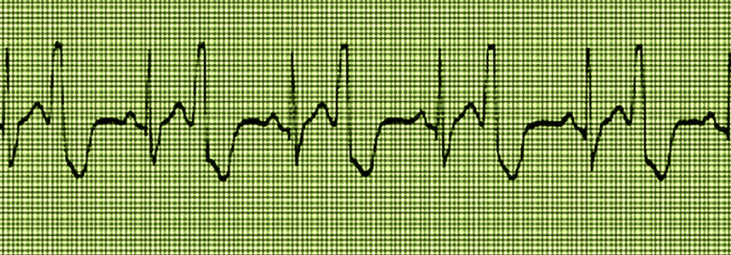 Rhythm Strip Identification Quiz 2 | Arrhythmia Interpretation Practice ...