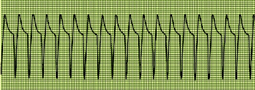 Rhythm Strip Identification Quiz 2 | Arrhythmia Interpretation Practice ...
