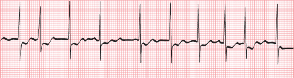 ECG Basic Principles Quiz 1 | Arrhythmia Interpretation Practice Test ...
