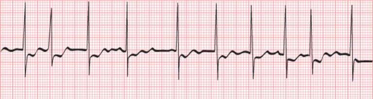ECG Basic Principles Quiz 1 | Arrhythmia Interpretation Practice Test ...