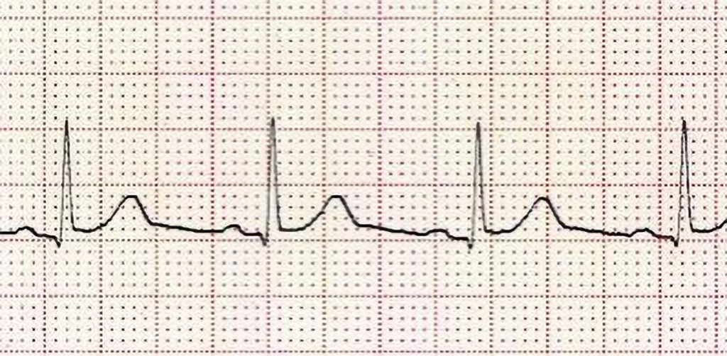 ECG Basic Principles Quiz 2 | Arrhythmia Interpretation Practice Test ...