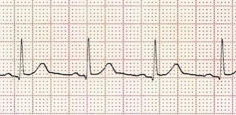 ECG Basic Principles Quiz 2 | Arrhythmia Interpretation Practice Test ...