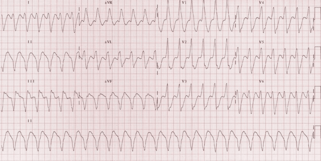 Arrhythmias Quiz 1 | ACLS Practice Test Online | ACLS Certification ...
