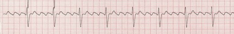 Atrial Rhythms Quiz | 12-Lead ECG Practice Test Online | ACLS ...