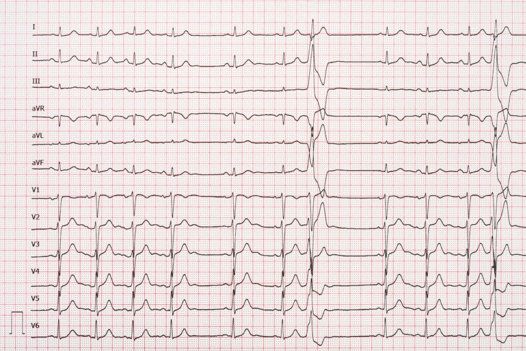 Topic - Monitoring the Leads | Arrhythmia Interpretation Certification ...