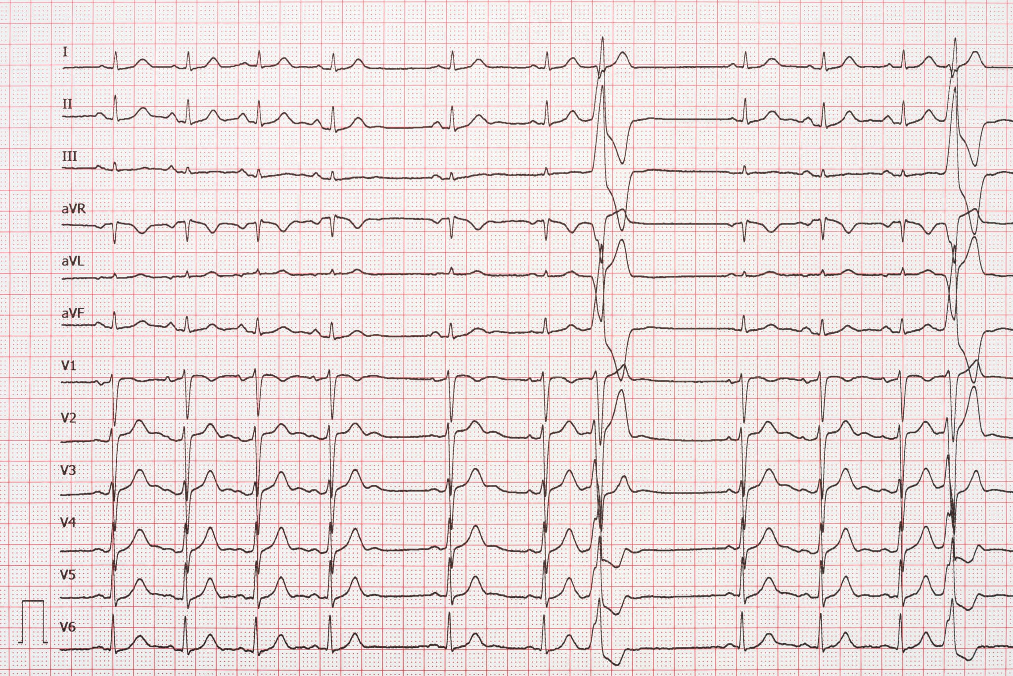 Topic - Monitoring the Leads | Arrhythmia Interpretation Certification ...