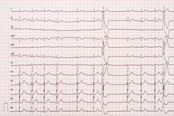 Topic - Monitoring the Leads | Arrhythmia Interpretation Certification ...