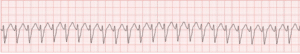 ACLS Megacode Scenario 1 | ACLS Simulator | ACLS Certification Association