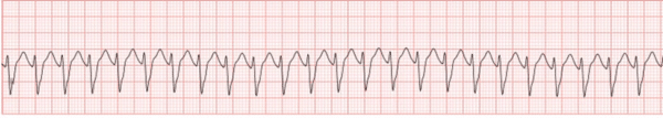 ACLS Megacode Scenario 1 | ACLS Simulator | ACLS Certification Association