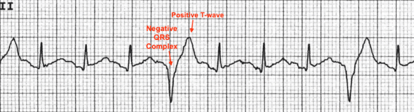 Topic - Premature Ventricular Complexes | Arrhythmia Interpretation ...