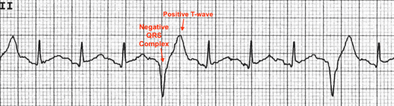 Topic - Premature Ventricular Complexes | Arrhythmia Interpretation ...