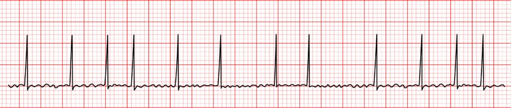 Topic - Atrial Fibrillation | Arrhythmia Interpretation Certification ...