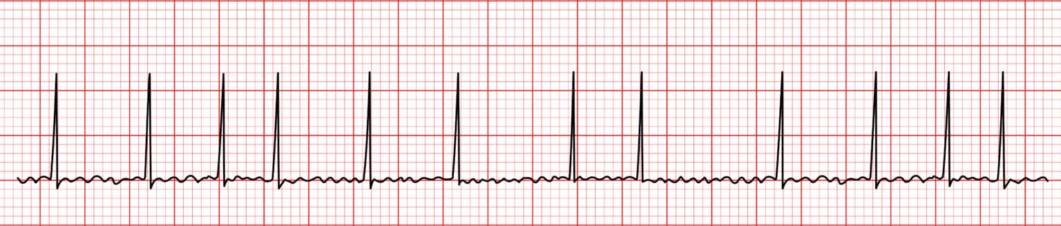 Topic - Atrial Fibrillation | Arrhythmia Interpretation Certification ...