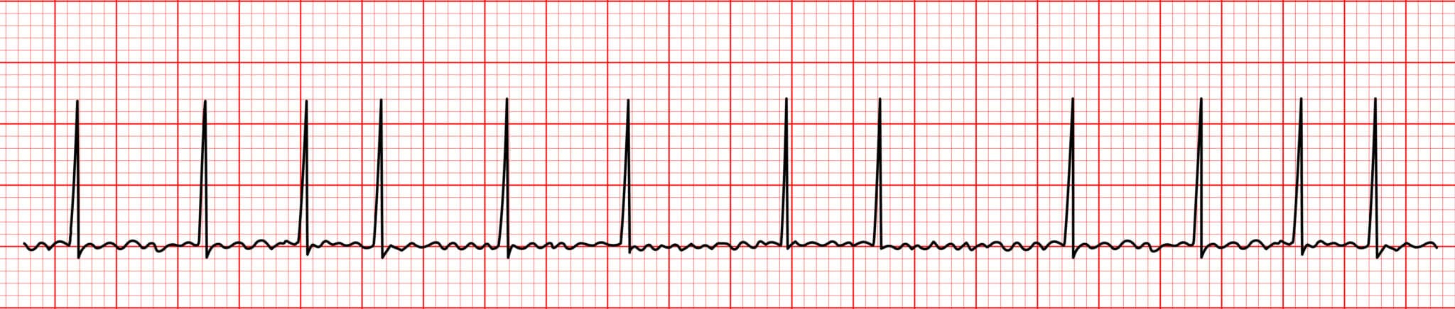 Topic - Atrial Fibrillation | Arrhythmia Interpretation Certification ...