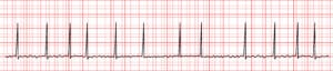 Topic - Atrial Fibrillation | Arrhythmia Interpretation Certification ...