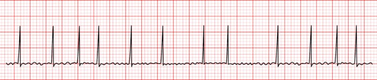 Topic - Atrial Fibrillation | Arrhythmia Interpretation Certification ...