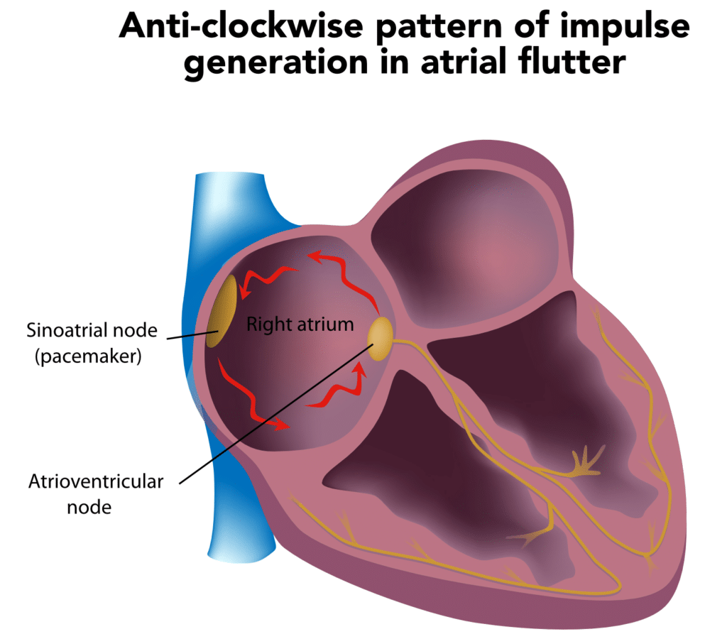 Topic - Atrial Flutter | Arrhythmia Course | ACLS Certification Association