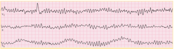 Topic - Ventricular Fibrillation | Arrhythmia Interpretation ...