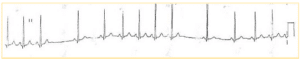 Topic - Sinoatrial Node Exit Block (AV Blocks) | Arrhythmia ...