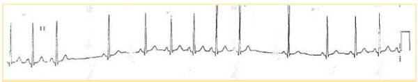 Topic - Sinoatrial Node Exit Block (AV Blocks) | Arrhythmia ...